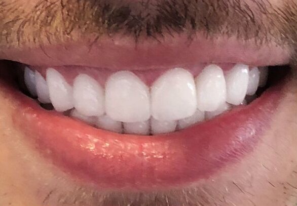 Before And After - OMS Dental